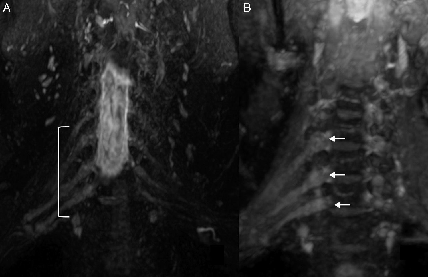 High resolution neurography of the brachial plexus by 3Tesla magnetic ...