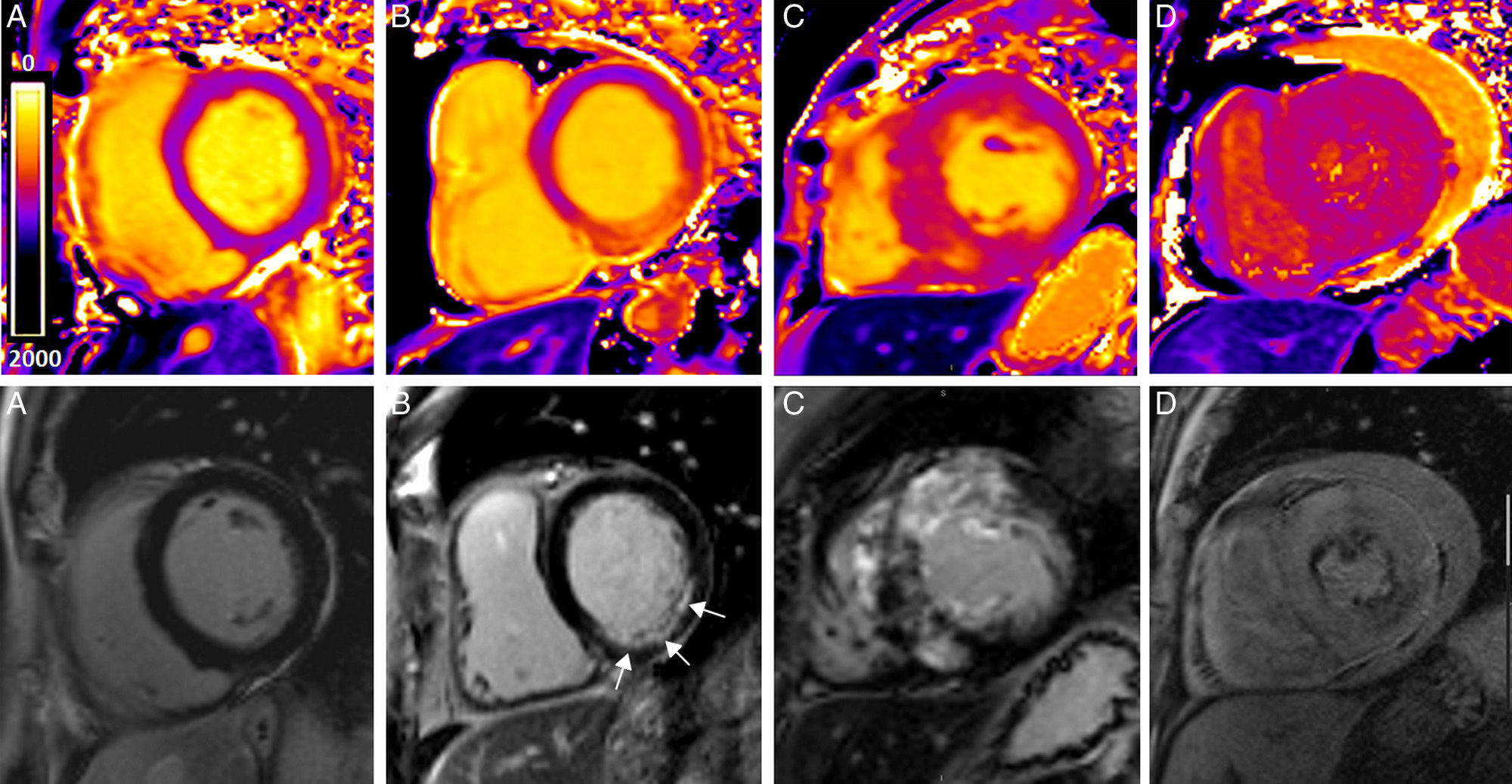 Parametric techniques for characterizing myocardial tissue through ...
