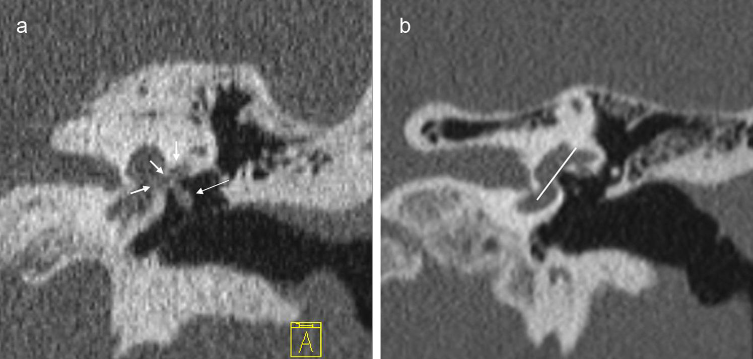 Update on the imaging diagnosis of otosclerosis | Radiología (English ...