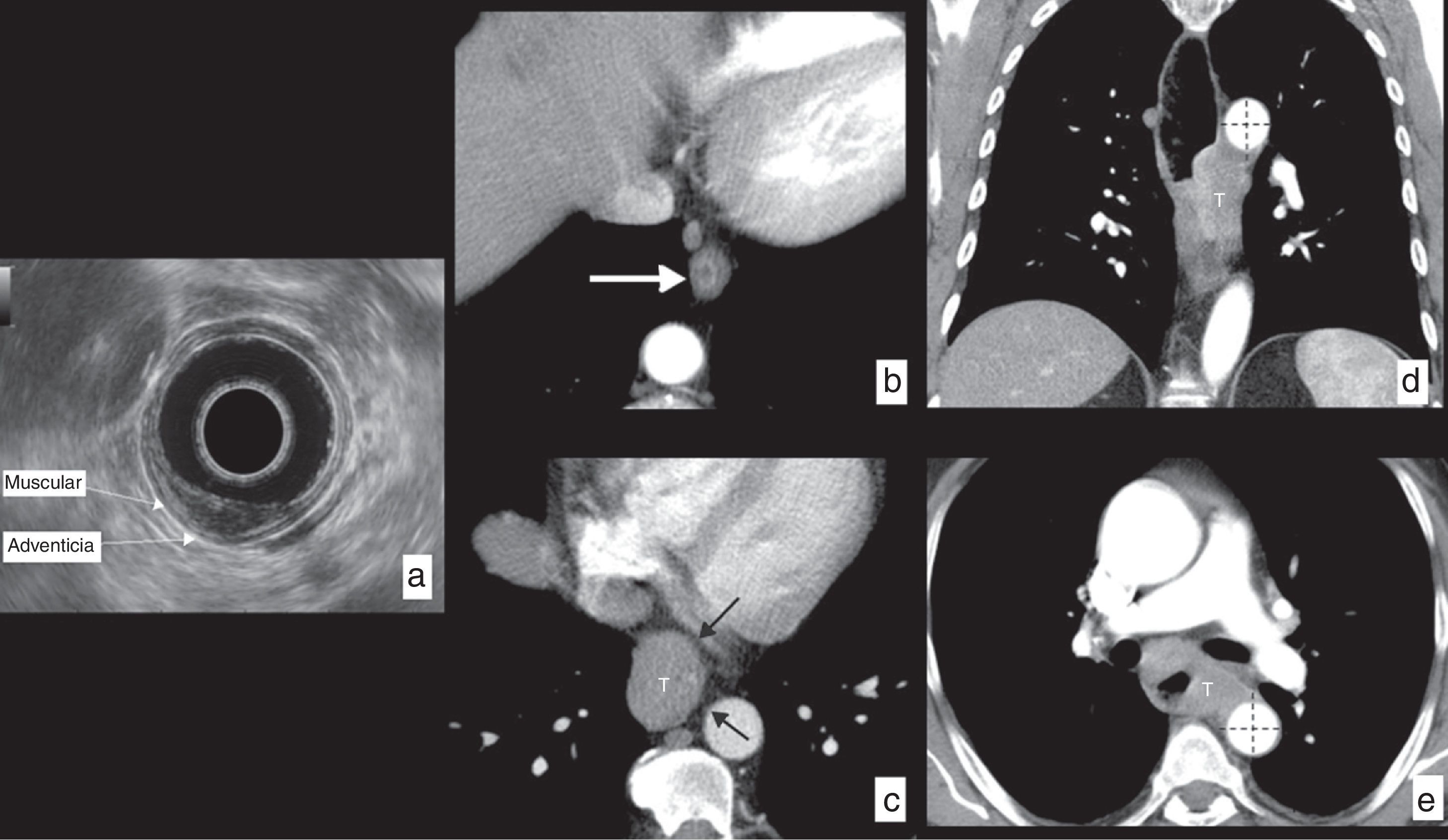 Esophageal cancer: Anatomic particularities, staging, and imaging ...