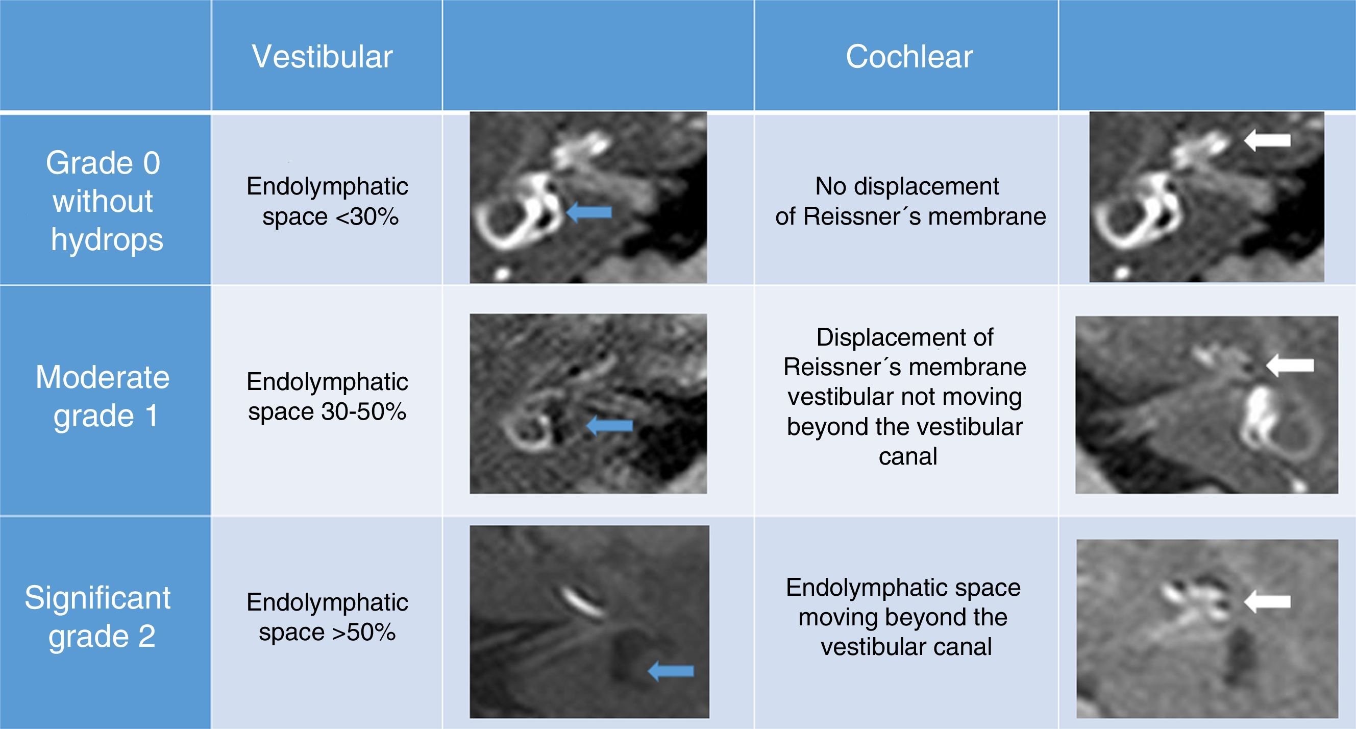 Diagnosis of endolymphatic hydrops by means of 3T magnetic resonance ...
