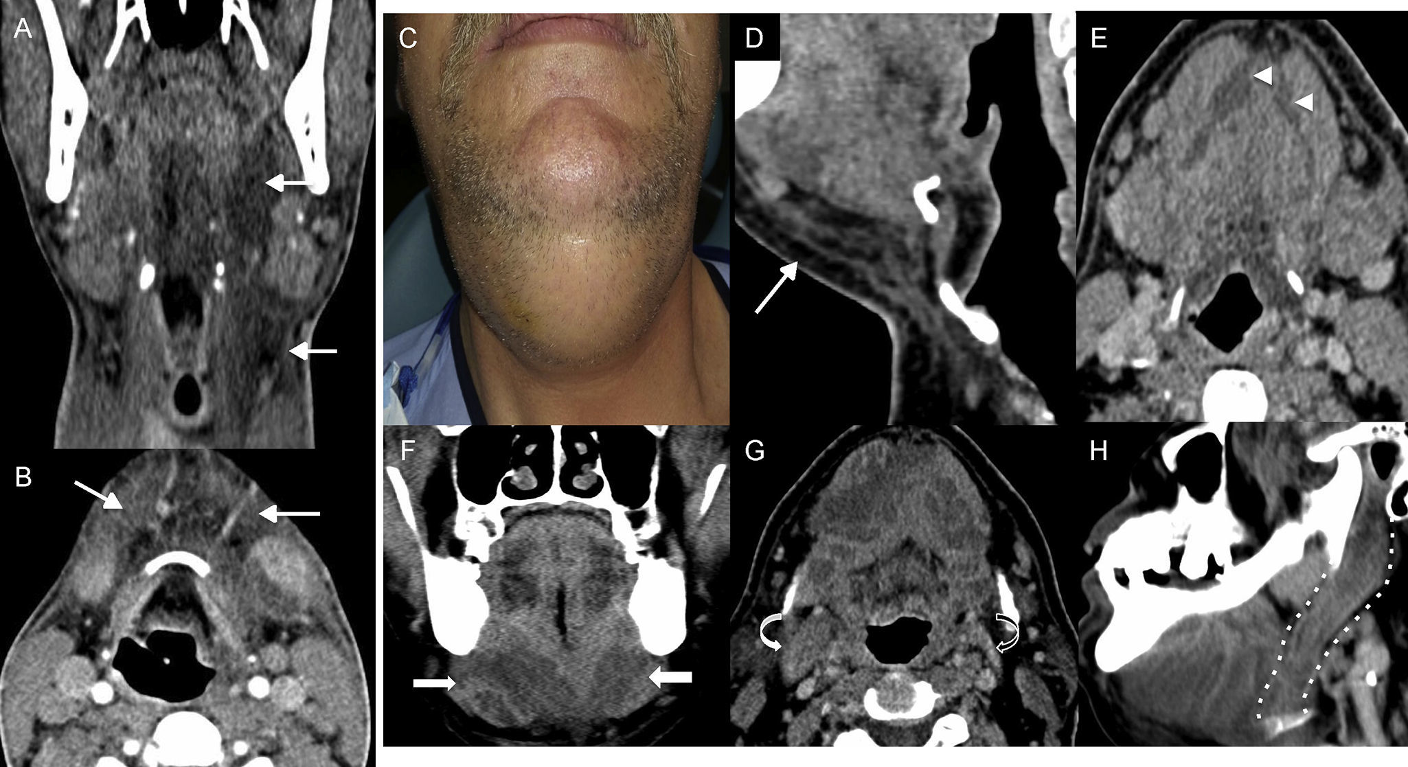 Nontraumatic head and neck injuries: A clinical approach. Part 2 ...