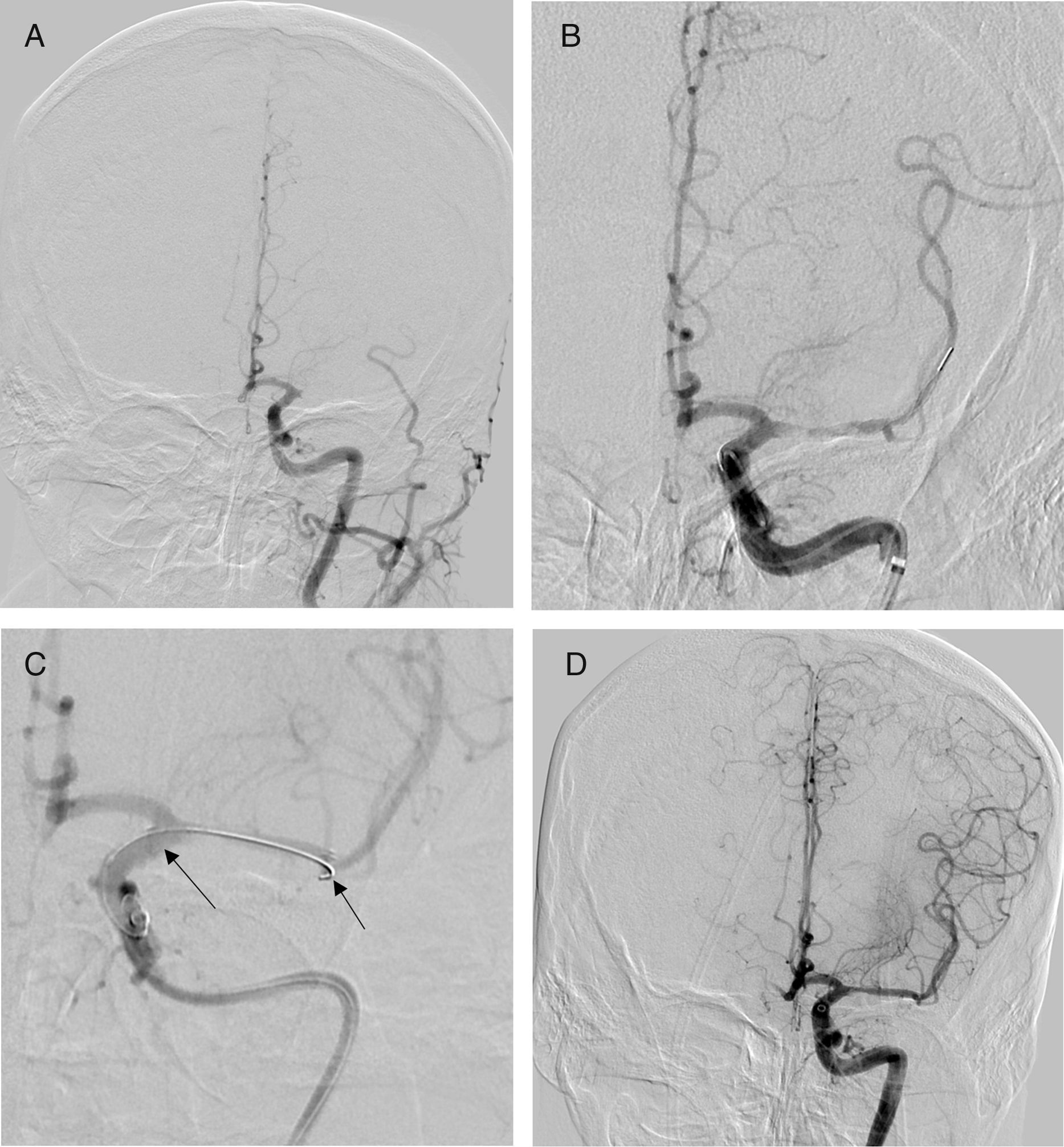 Intracranial stents in the endovascular treatment of acute ischemic ...