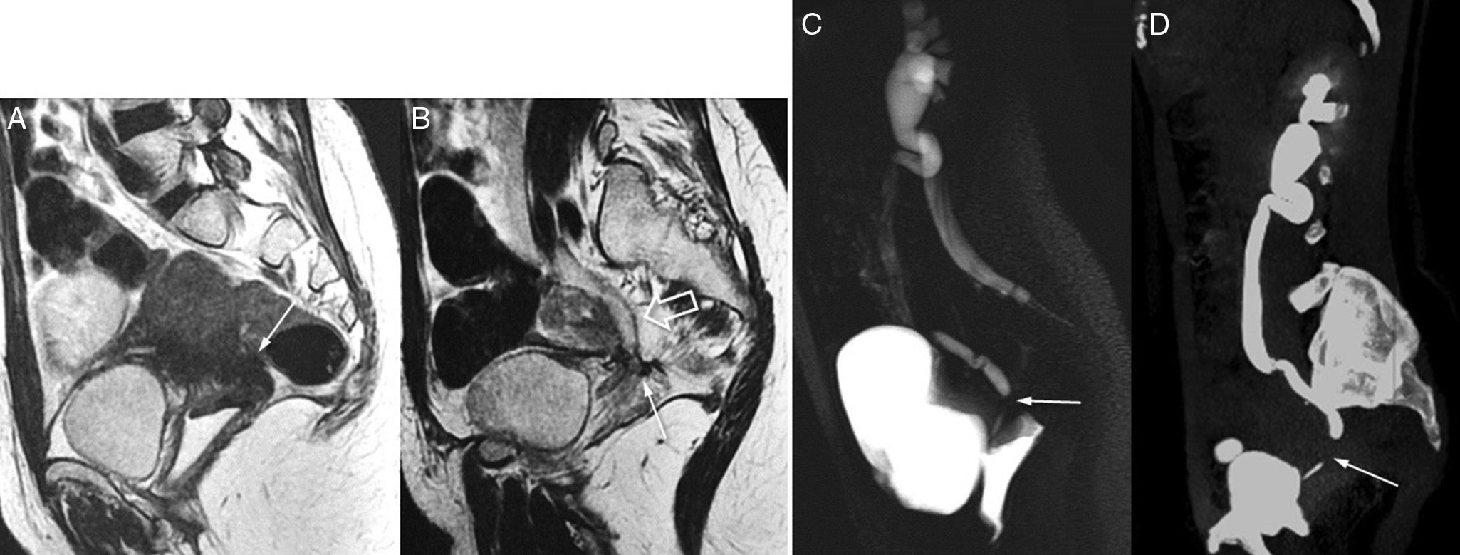 Magnetic resonance imaging of pelvic endometriosis | Radiología ...