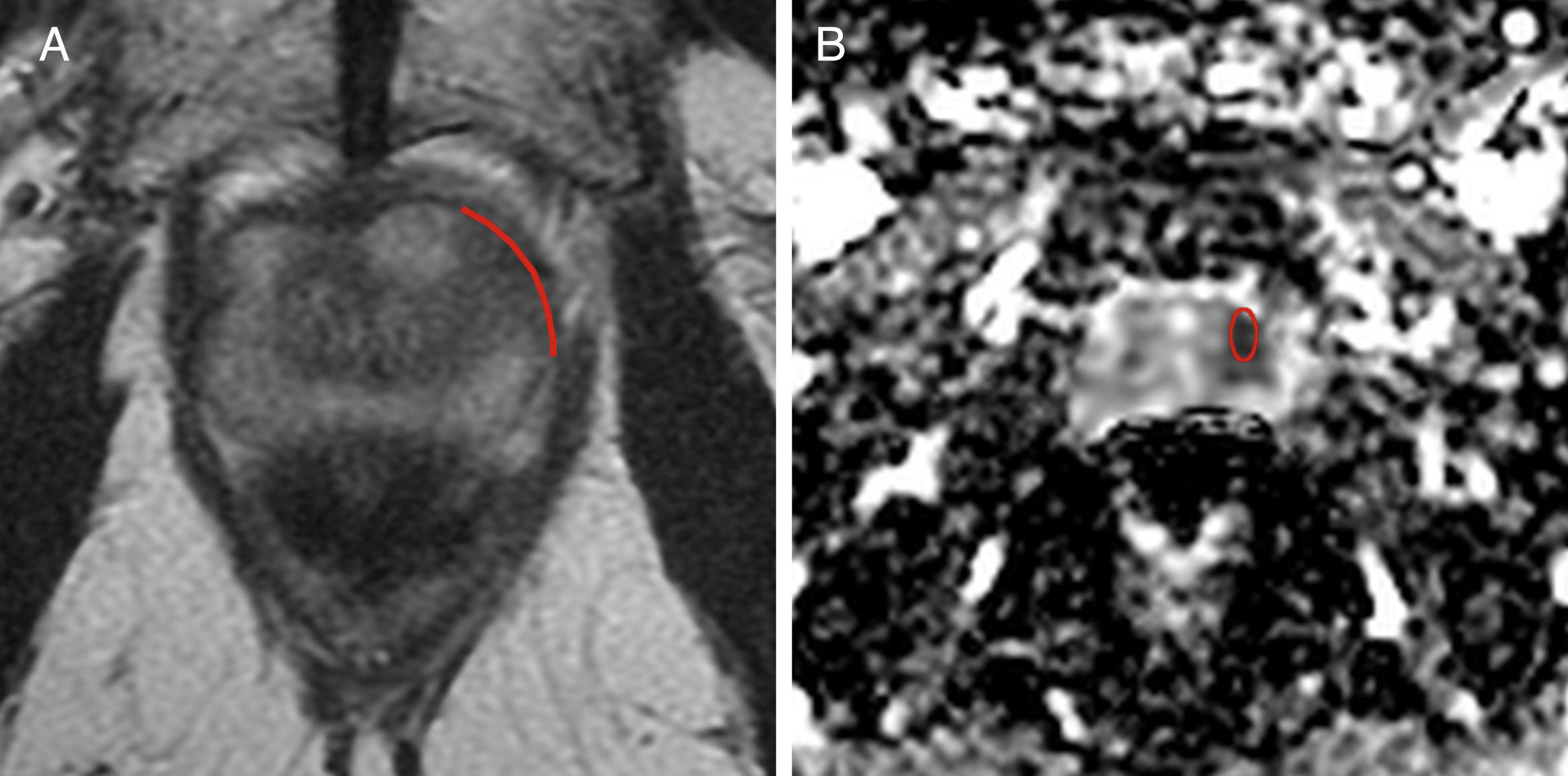 Predicting extracapsular involvement in prostate cancer through the ...