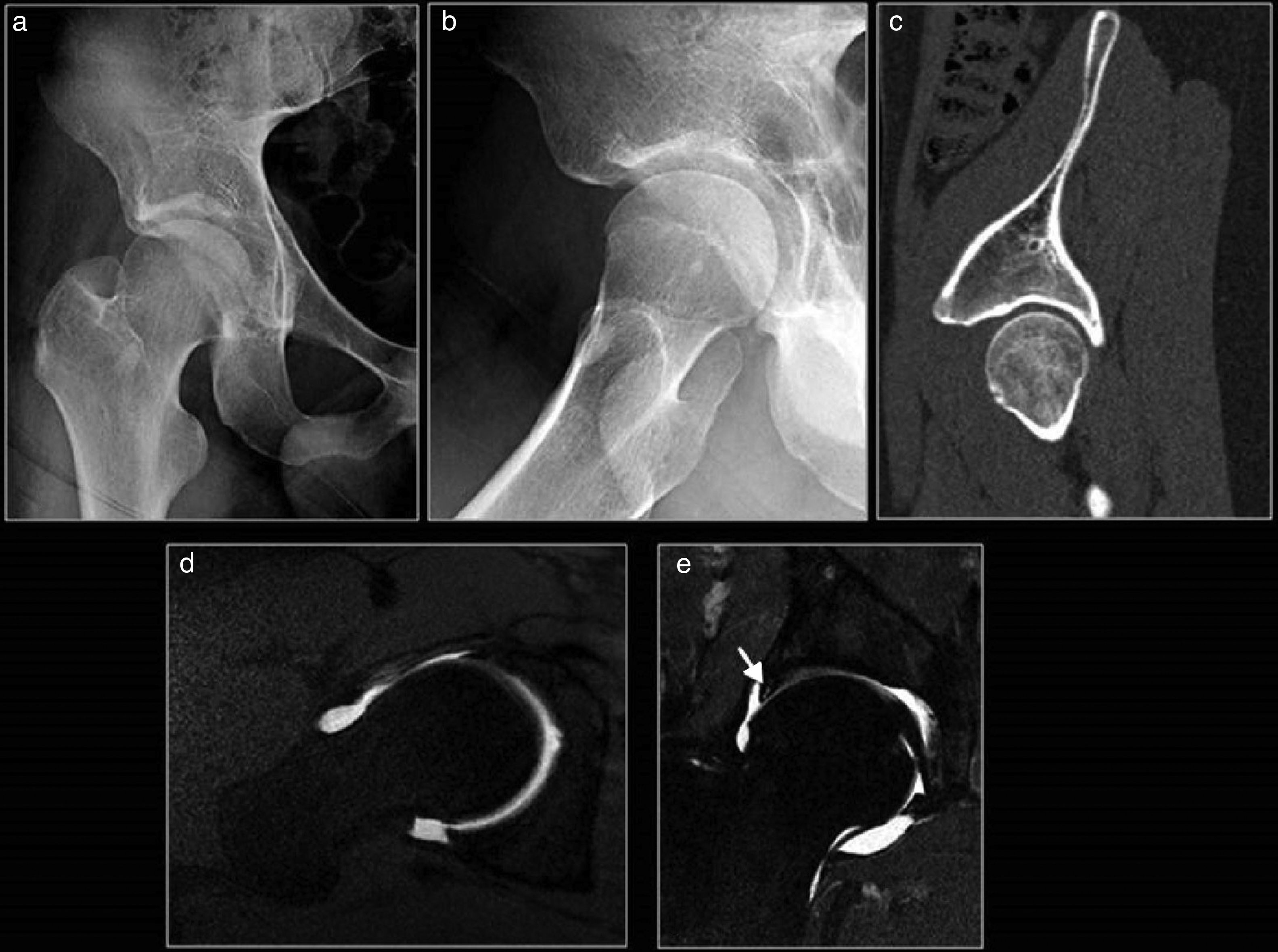 Extra-articular hip impingement: A review of the literature ...