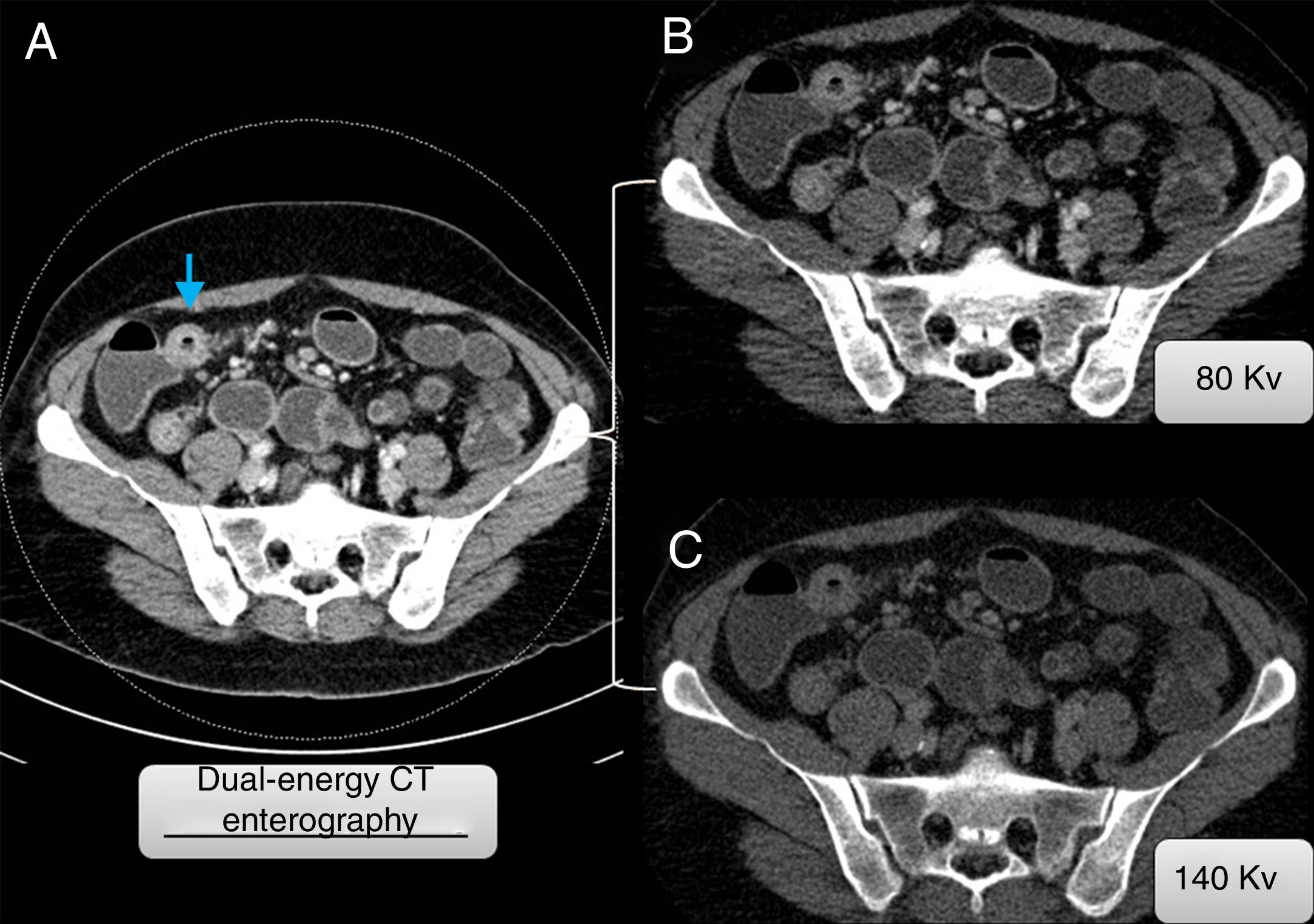 Value of dual-energy CT enterography in the analysis of pathological ...
