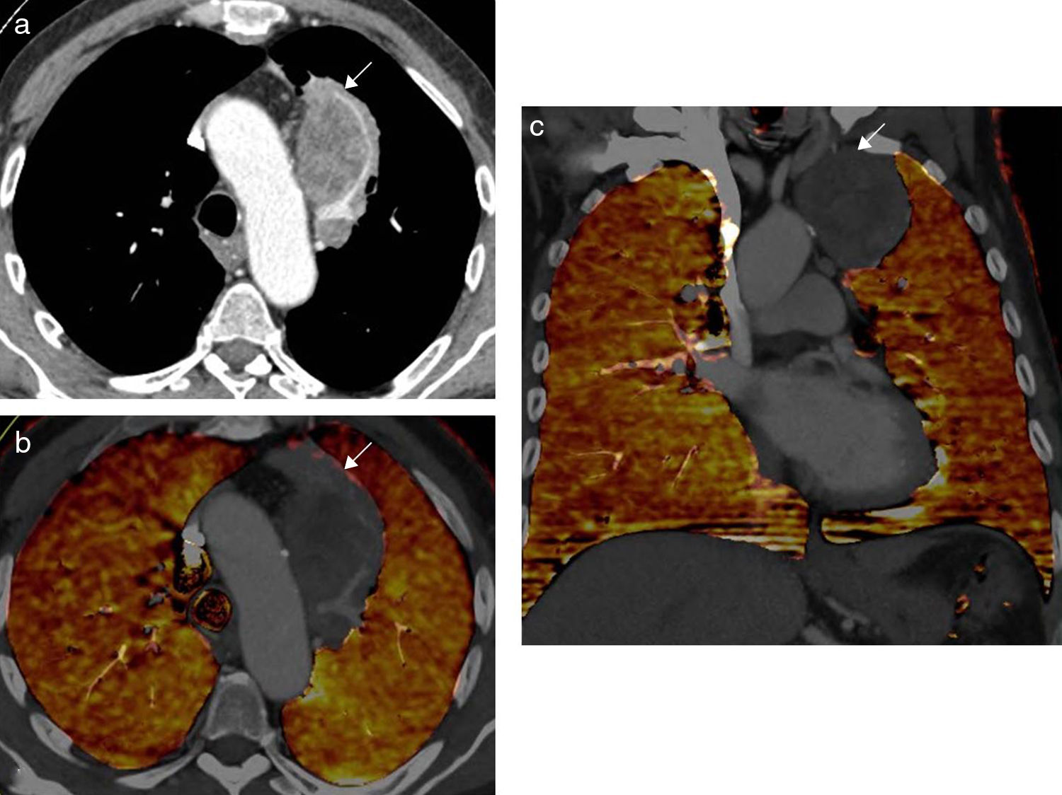 Perfusion defects in pulmonary perfusion iodine maps: Causes and ...