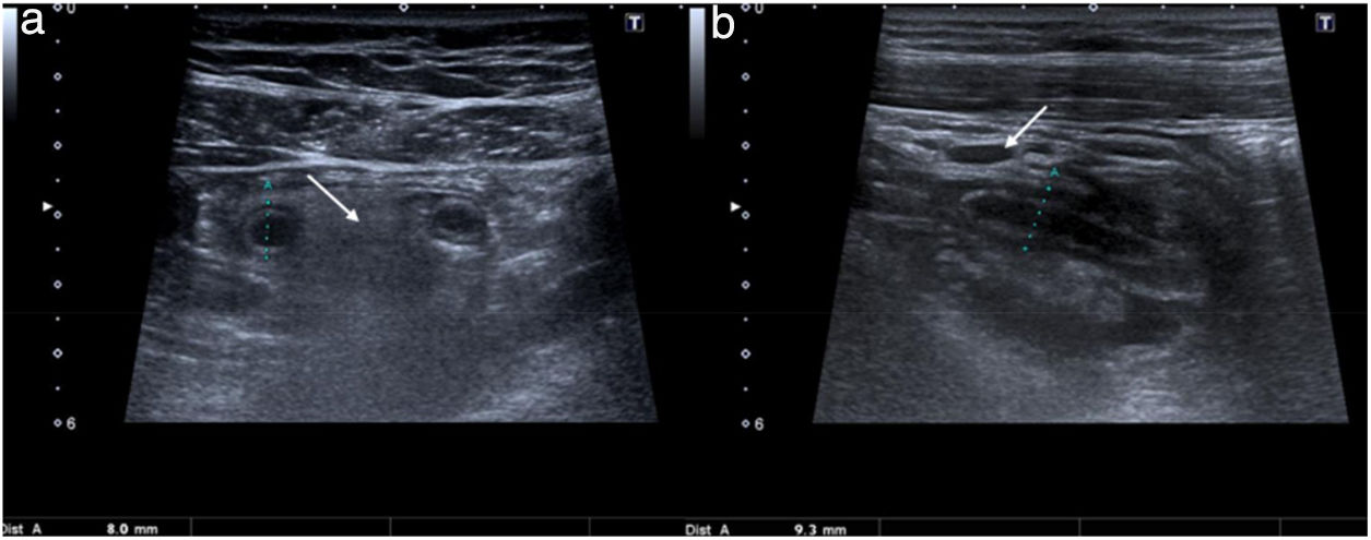 Suspicion of acute appendicitis in adults. The value of ultrasound in ...