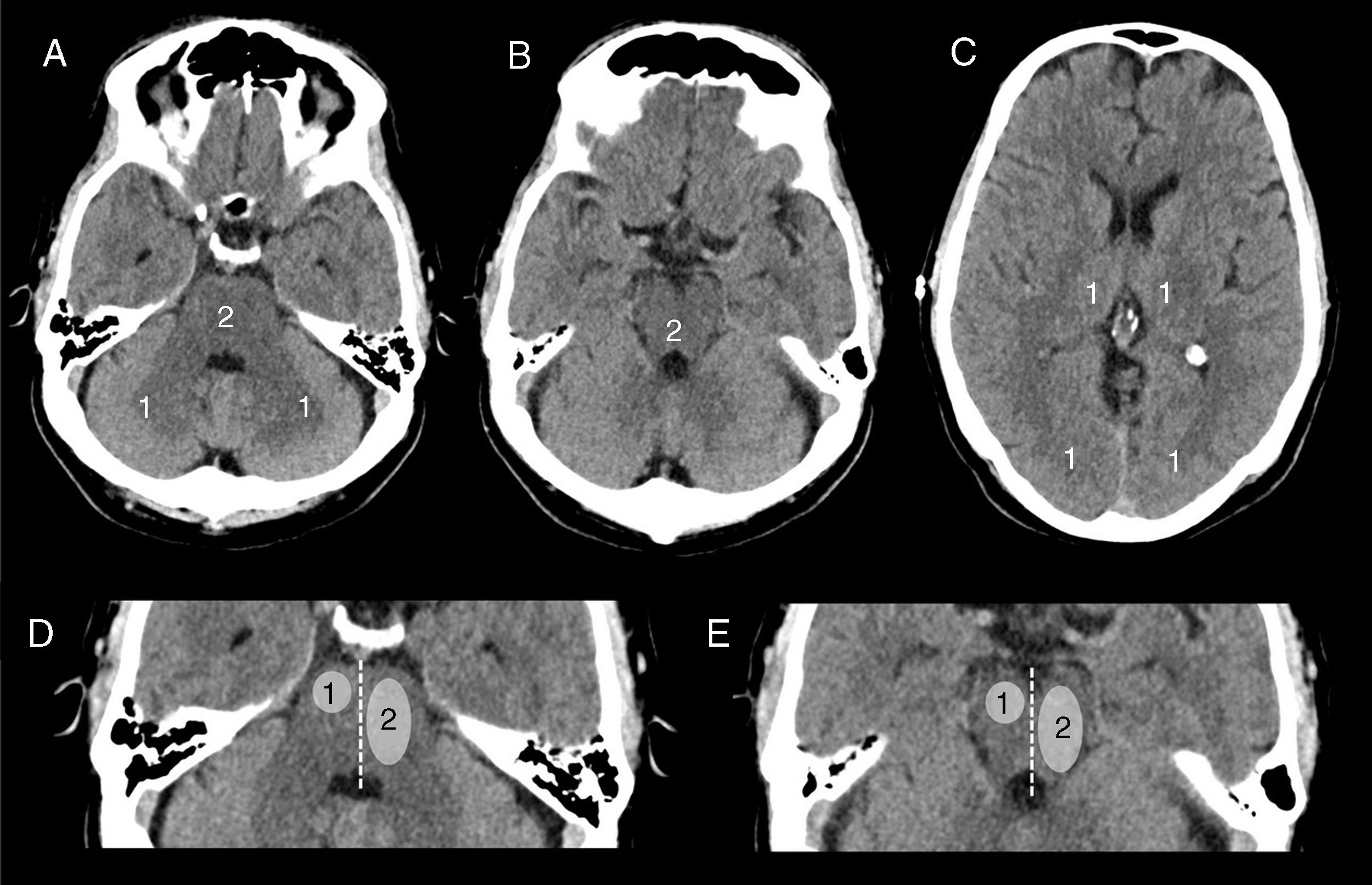 Value of Posterior circulation ASPECTS and Pons-Midbrain Index on non ...