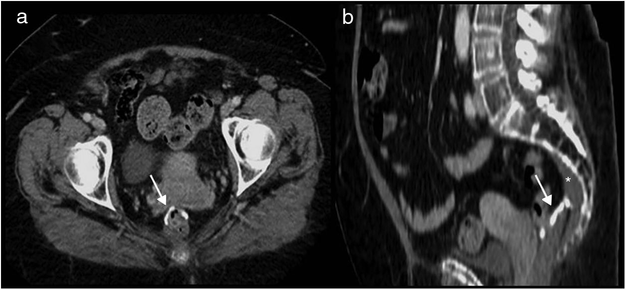 Urgent multidetector computed tomography in colon cancer: Postsurgical ...