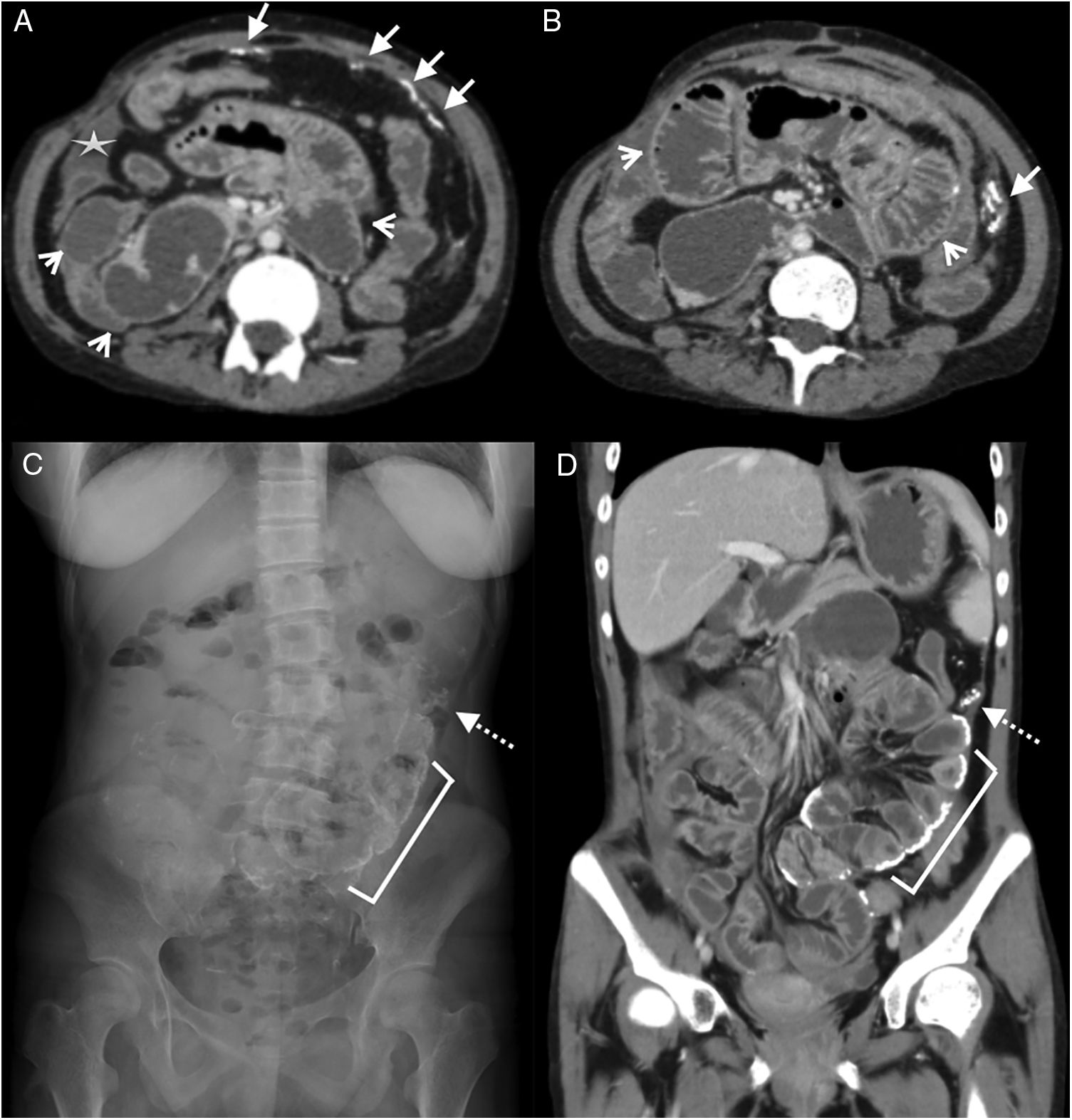 diffuse sclerosis ct