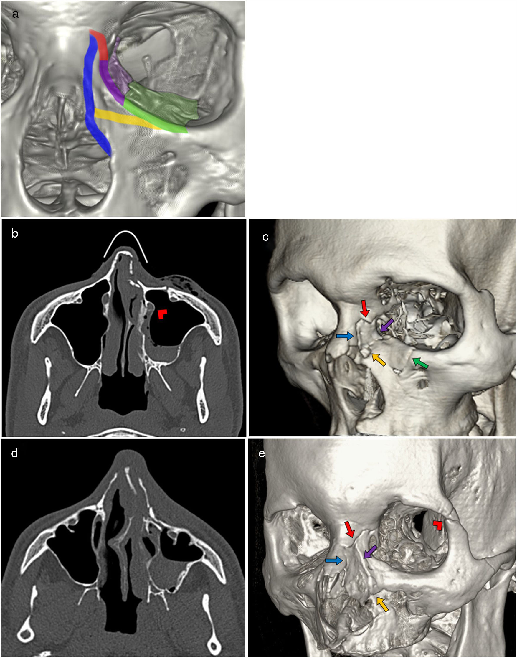 maxillary bone anatomy ct
