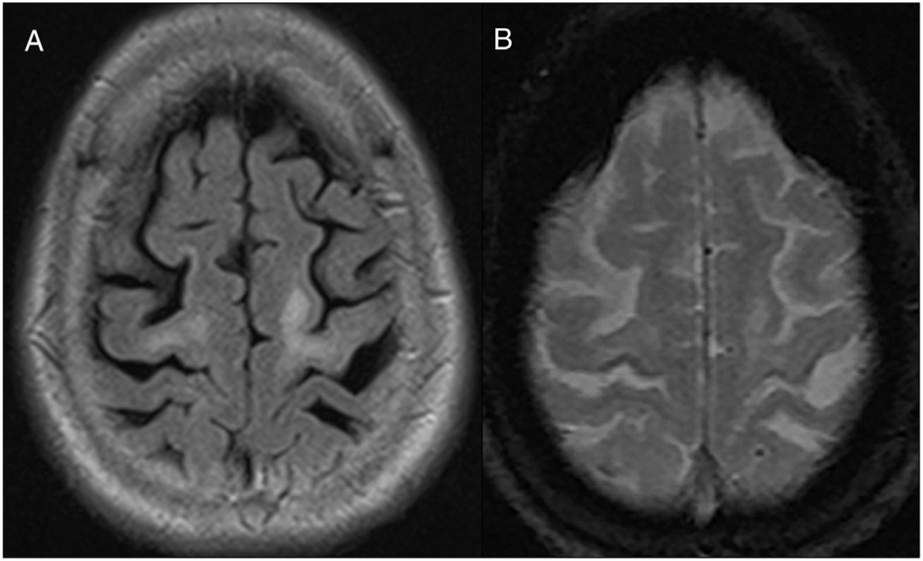 Cortical hypointensity in T2-weighted gradient-echo sequences in ...