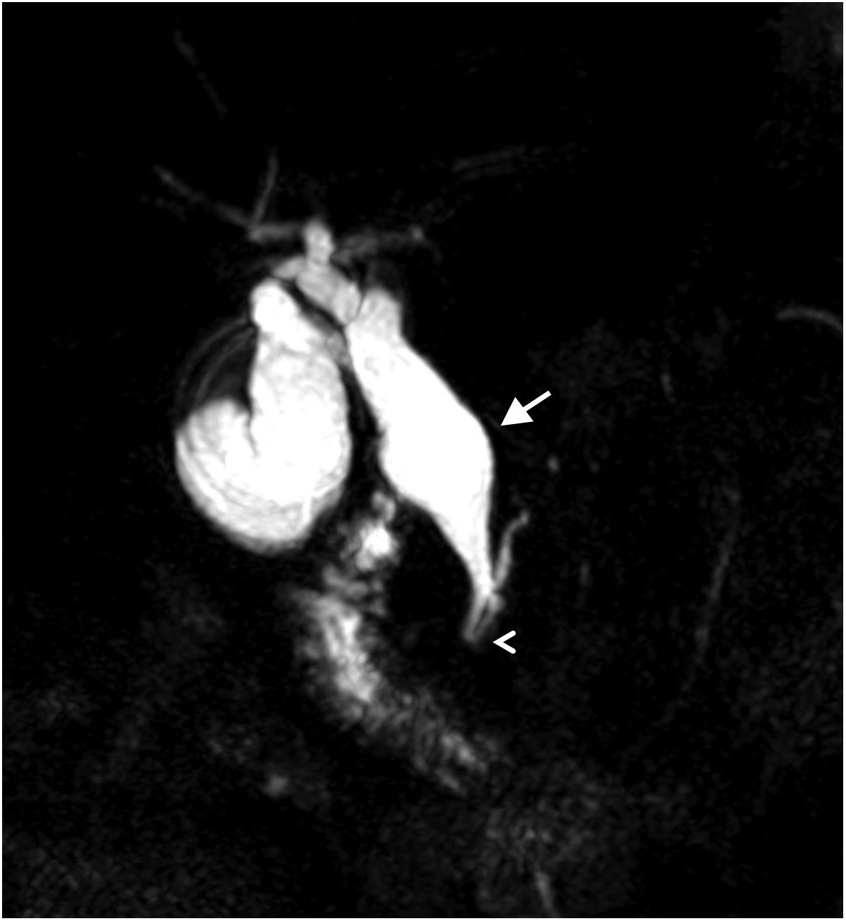 Intraductal papillary neoplasm of the bile duct: Radiologic findings in ...