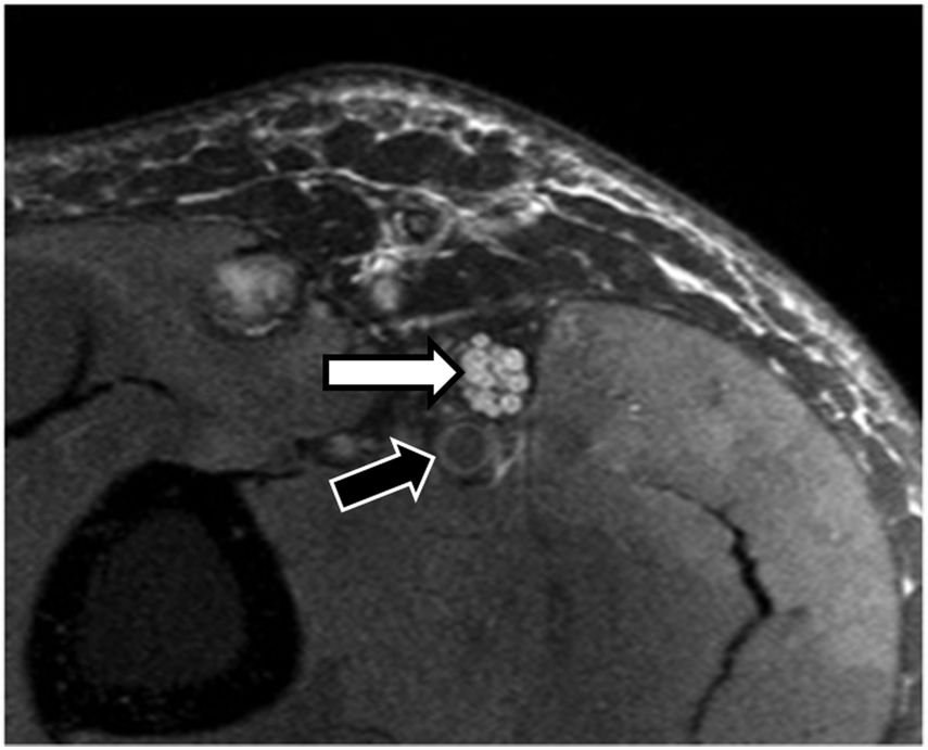 Update in the evaluation of peripheral nerves by MRI, from ...