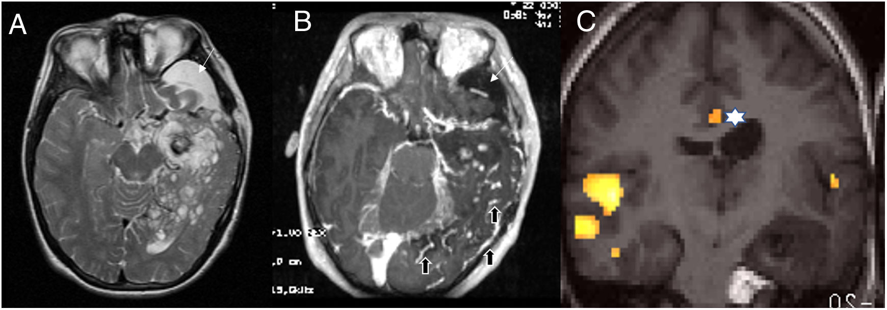 How to interpret images in epileptic seizures: correlation between ...