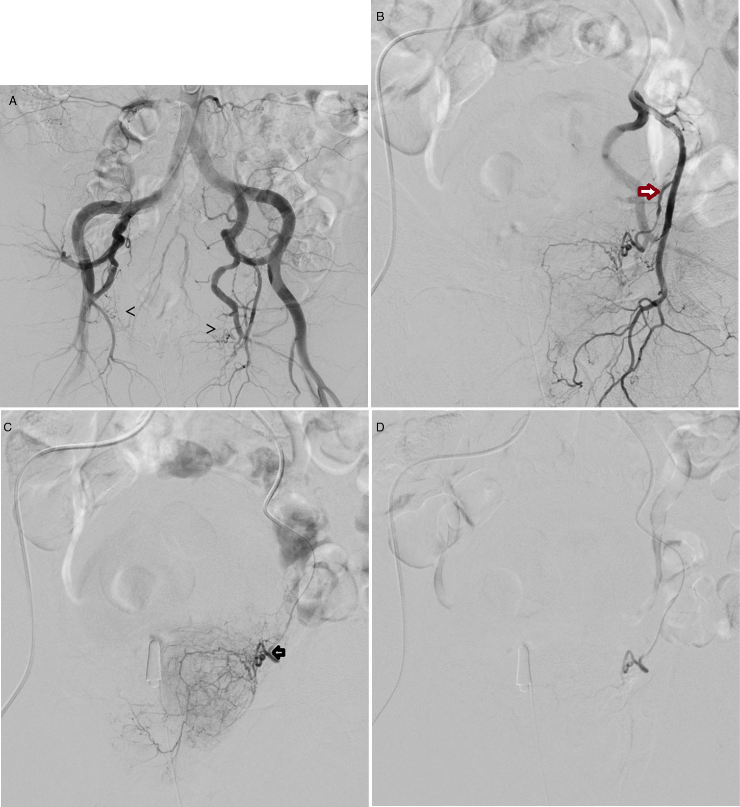 Embolisation of prostate arteries in benign prostatic hyperplasia in ...