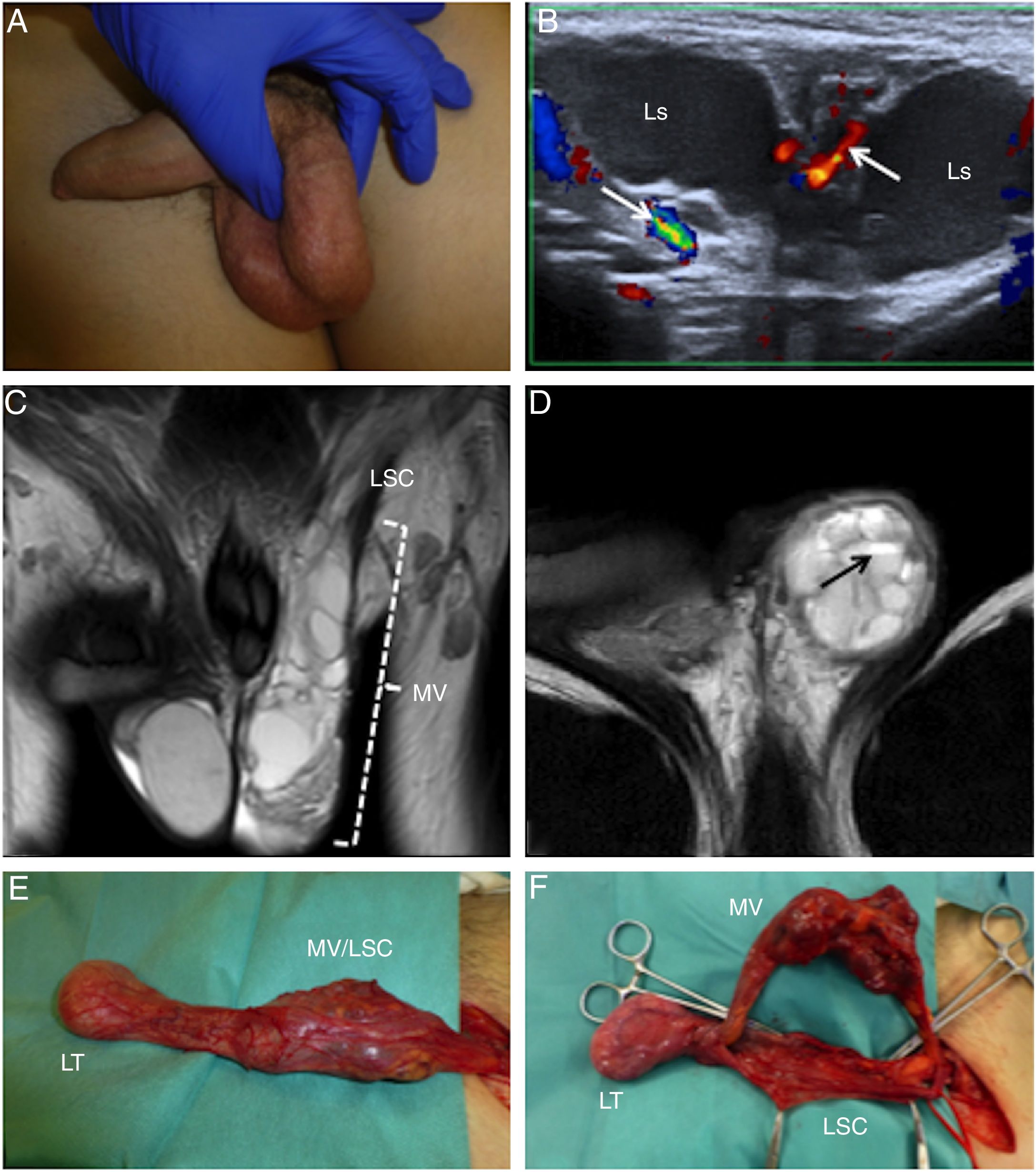 hypoechoic structure groin