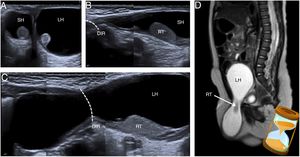 Paediatric groin lesions: Imaging findings | Radiología (English Edition)