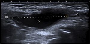 Paediatric groin lesions: Imaging findings | Radiología (English Edition)