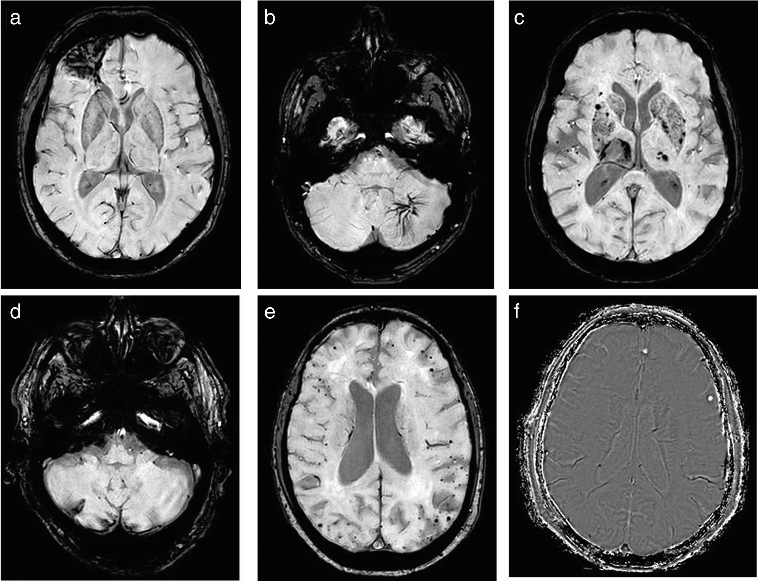 swi mri protocol