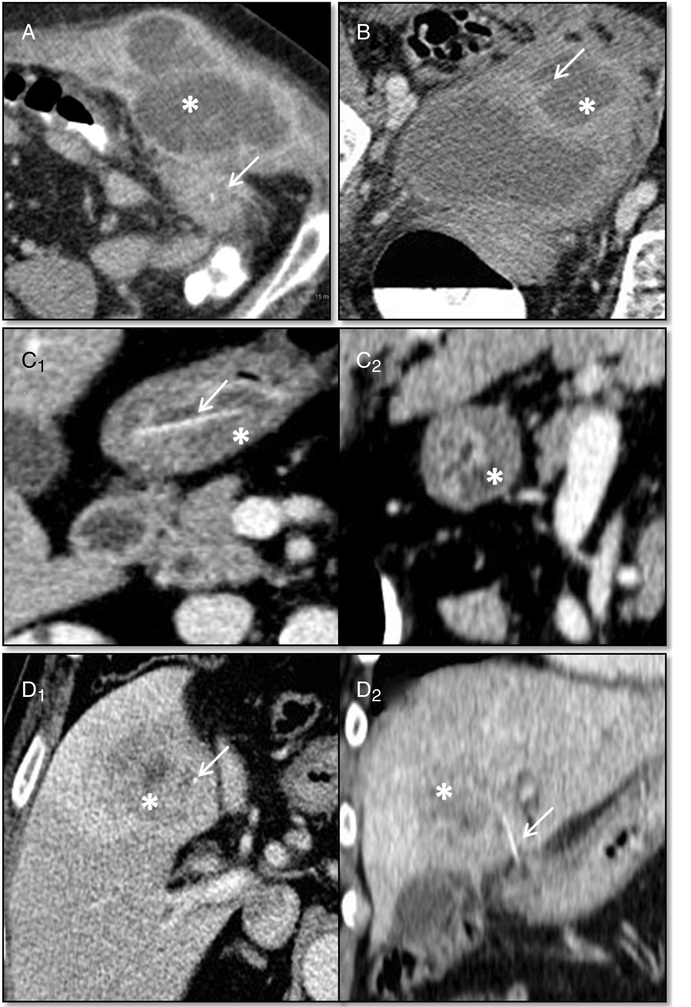 Gastrointestinal perforation caused by ingested fish bone. Computed ...