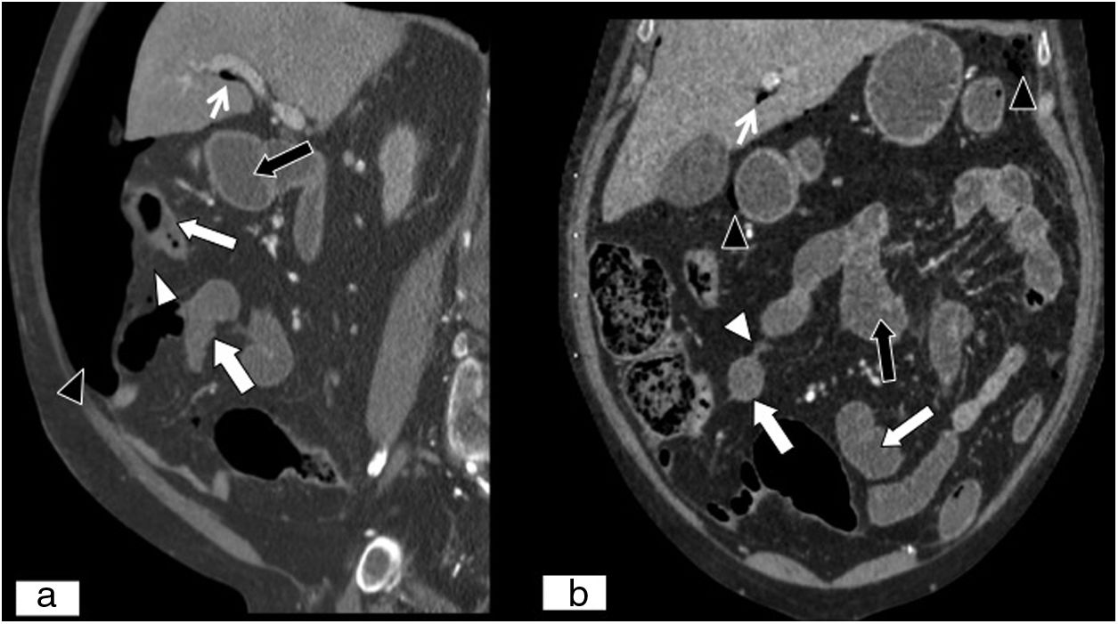 Acute mesenteric ischemia: A review of the main imaging techniques and ...