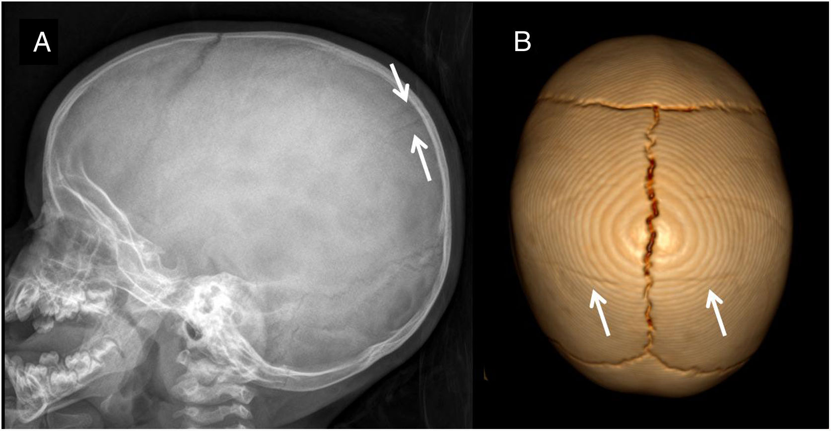 Linear skull fracture in infants after mild traumatic brain injury ...