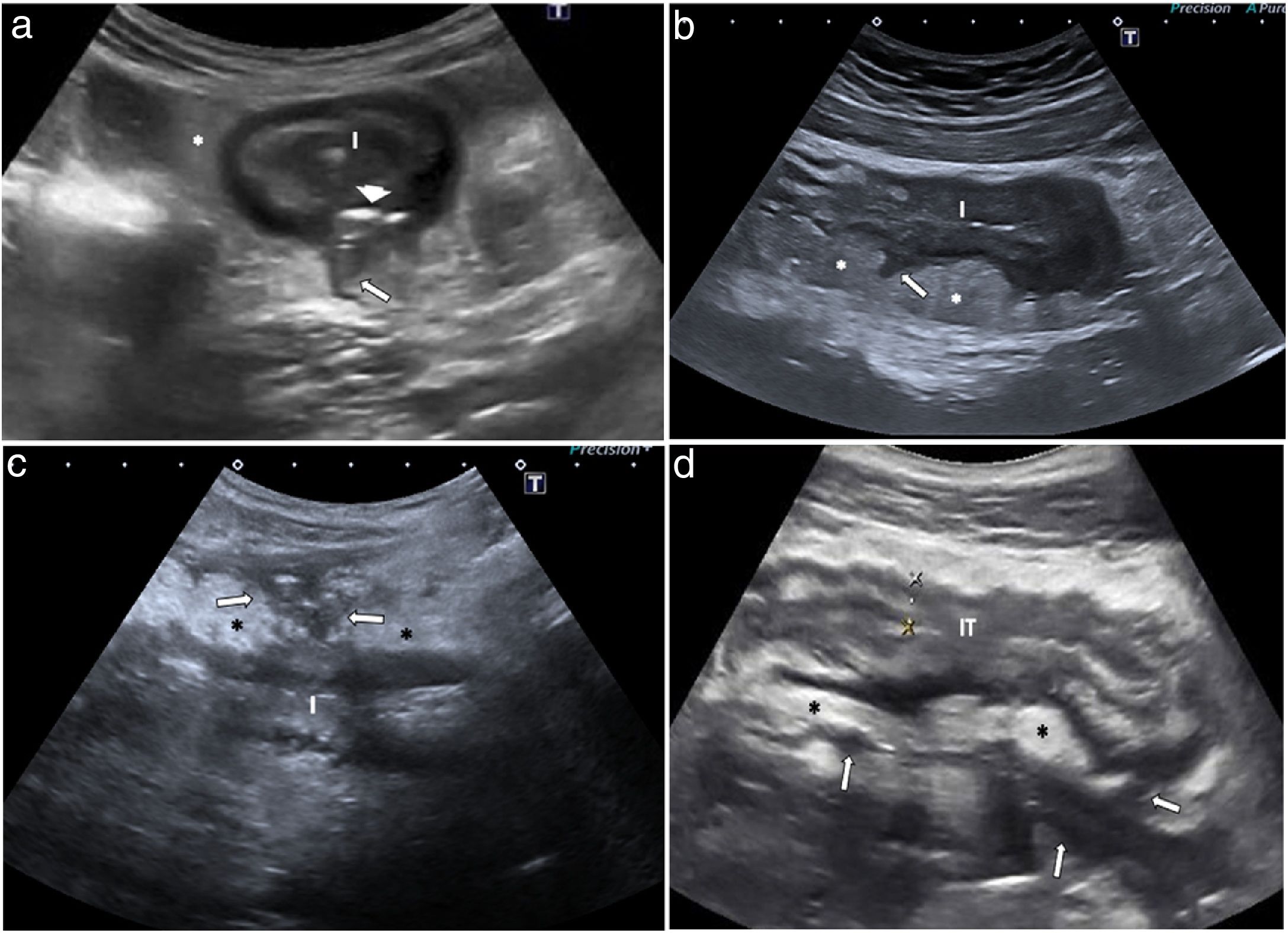 Usefulness of intestinal ultrasound in inflammatory bowel disease ...