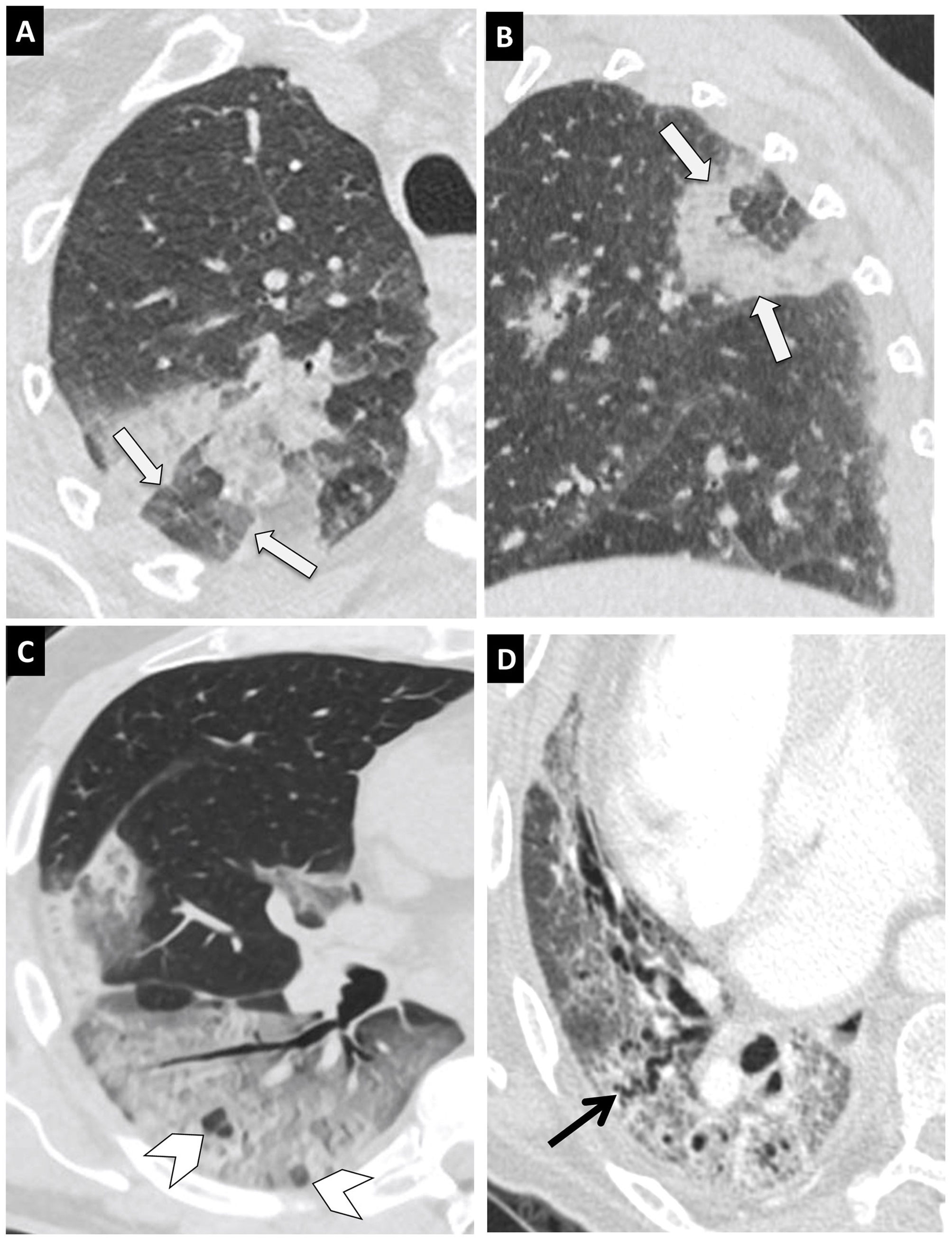 Radiologic diagnosis of patients with COVID-19 | Radiología (English ...