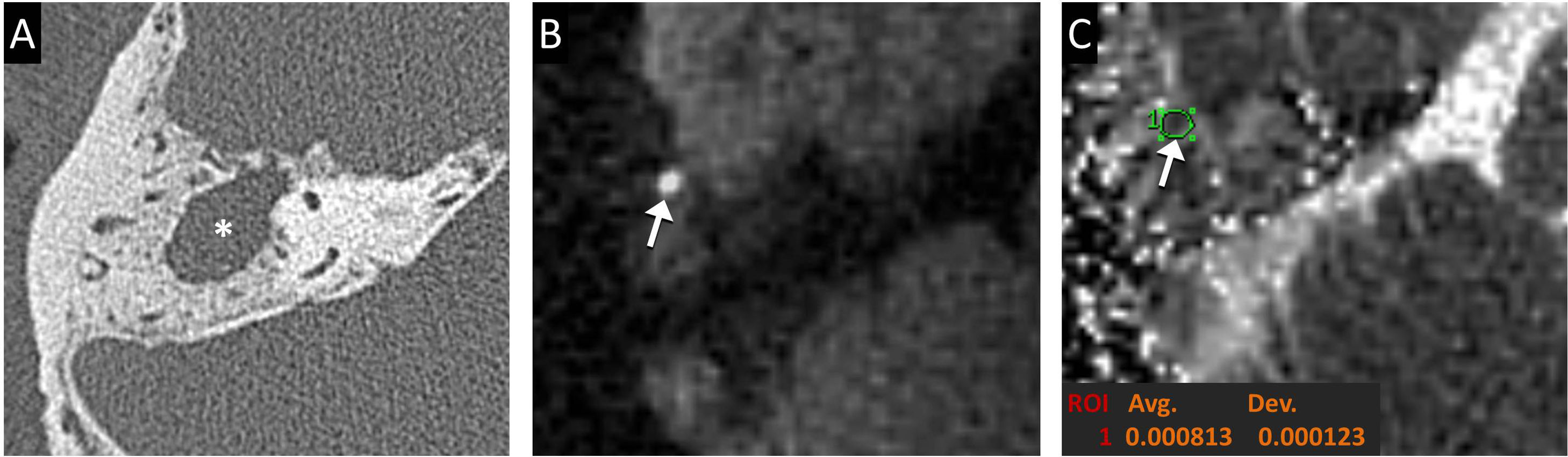 Radiological evaluation of the postsurgical middle ear | Radiología ...