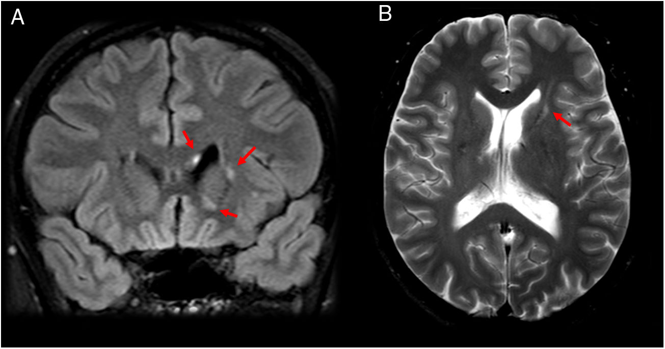 Atypical bacterial infections of the central nervous system transmitted ...