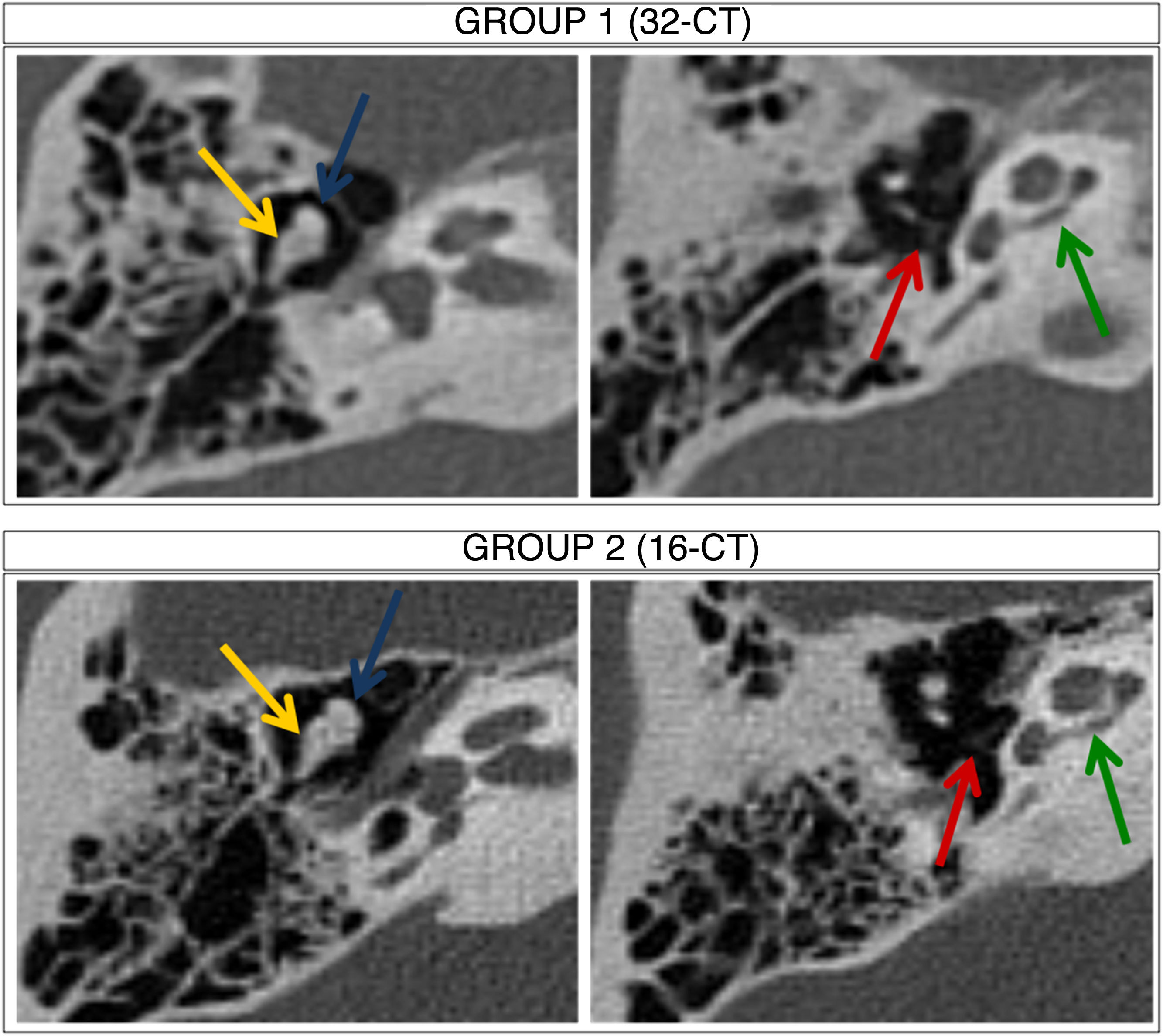Ultralow-dose CT of the petrous bone using iterative reconstruction ...