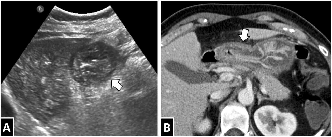 Anisakiasis: Imaging findings | Radiología (English Edition)