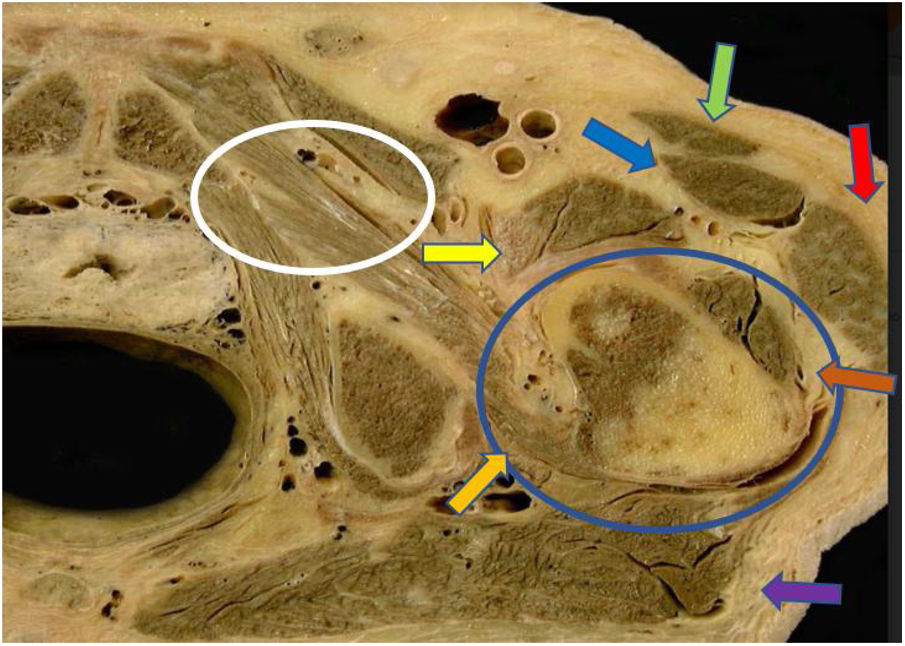 Role of imaging techniques in the diagnosis of selective hypertrophy of ...