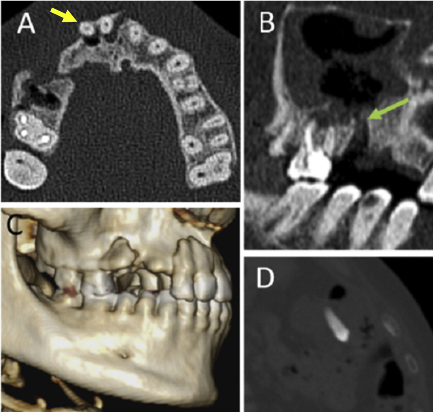 CT findings for dental disease | Radiología (English Edition)