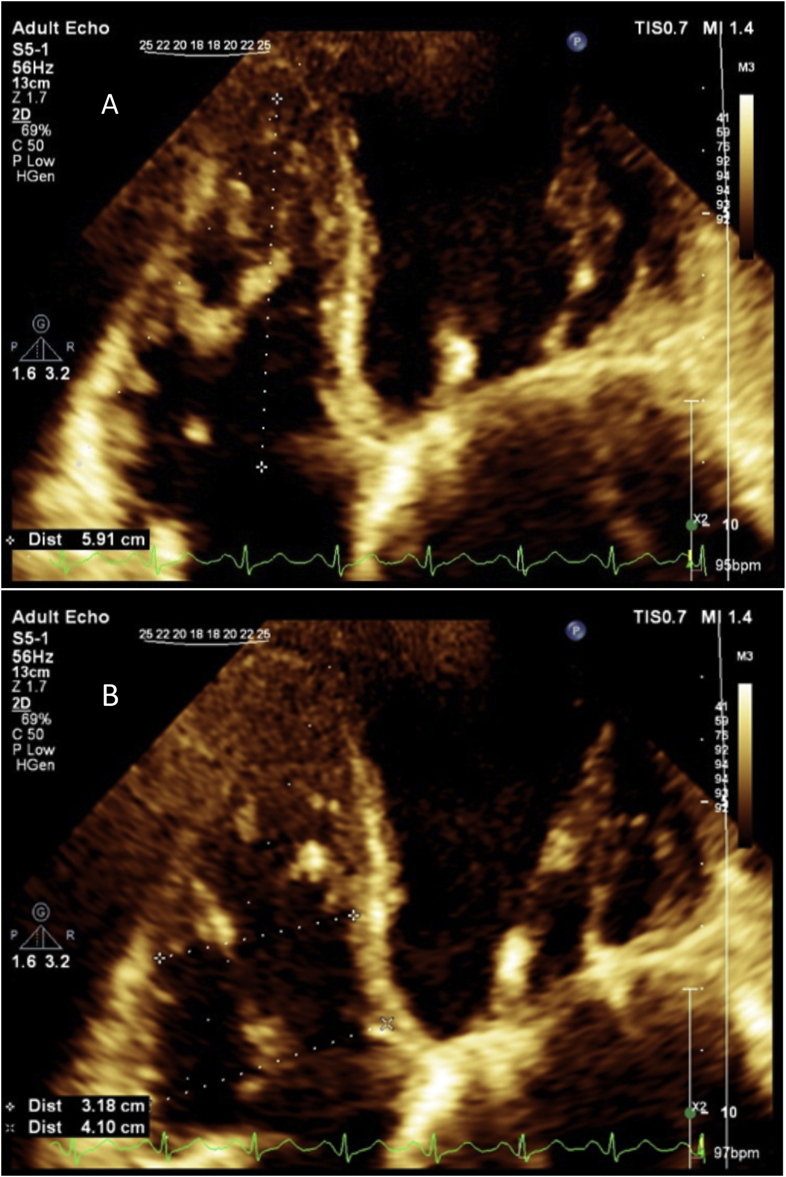 Pulmonary artery obstruction index, pulmonary artery diameter and right ...
