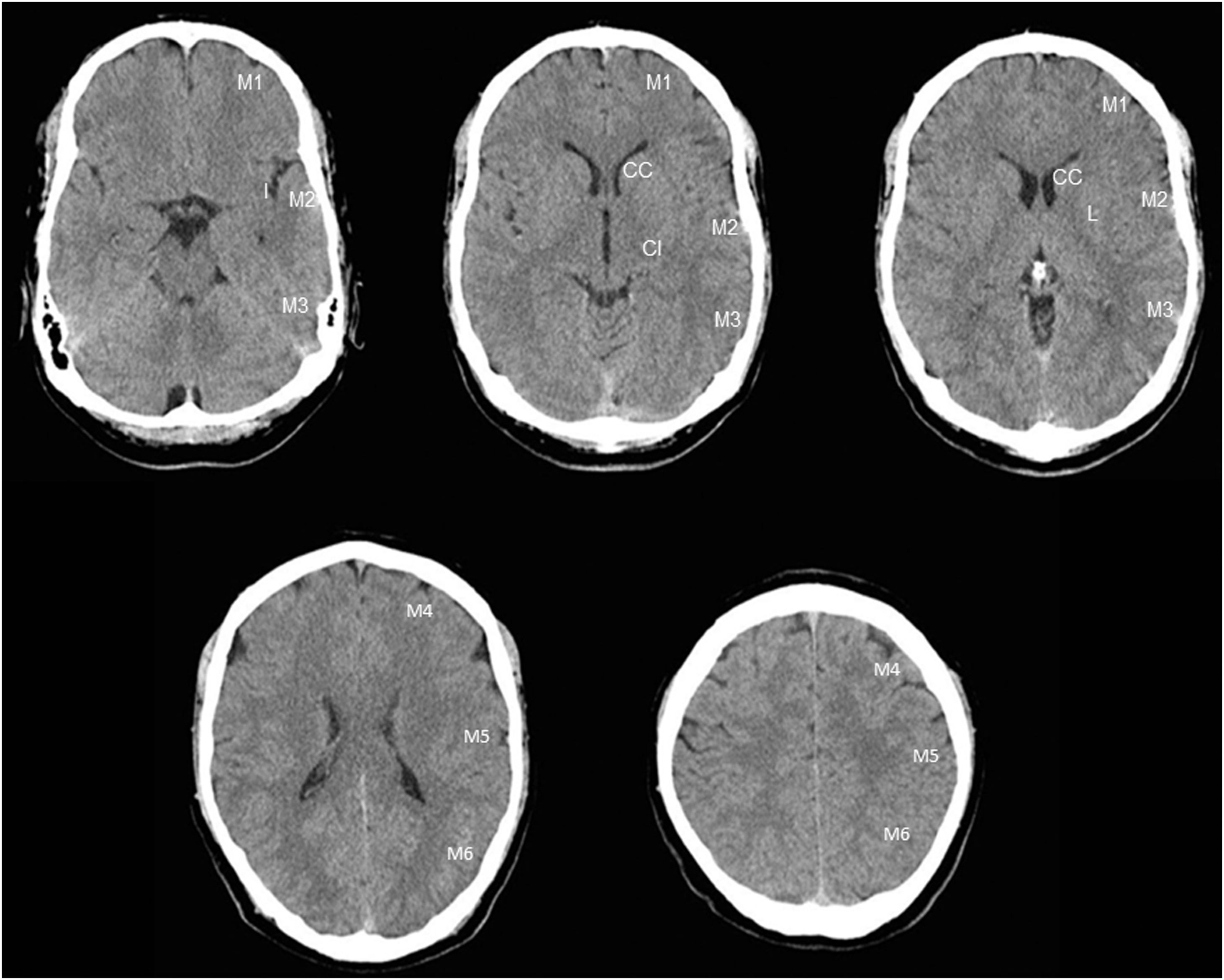 Update on imaging in Code Stroke | Radiología (English Edition)