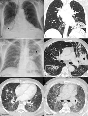 Schematic approach to the diagnosis of multifocal lung opacities in the ...
