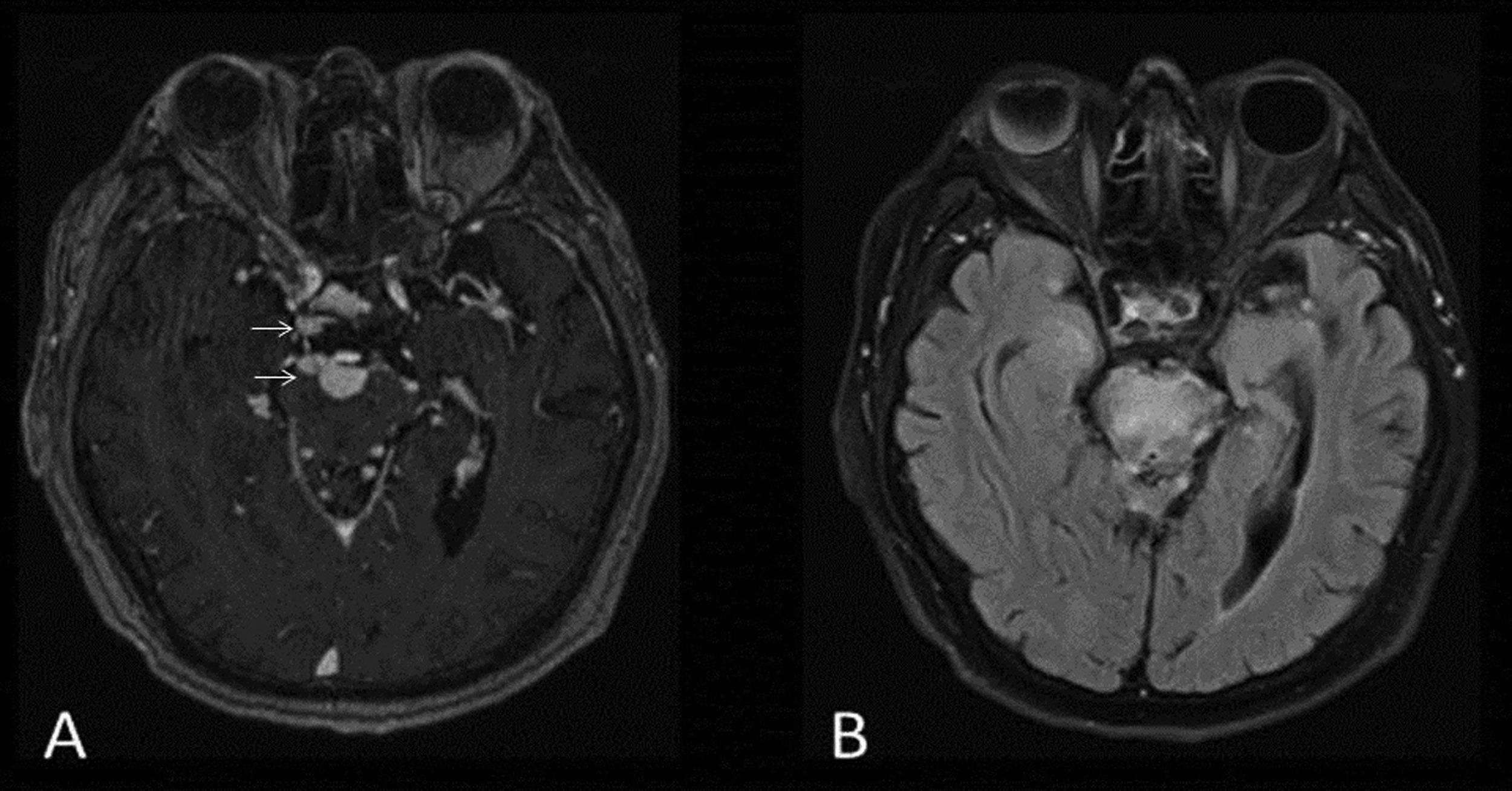 Inflammatory lesions of the brainstem: Keys for the diagnosis by MRI ...