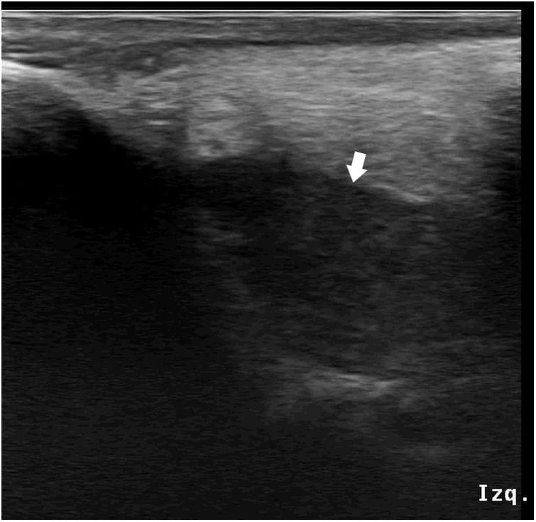 Complicated migraine: Importance of neuroimaging | Radiología (English ...