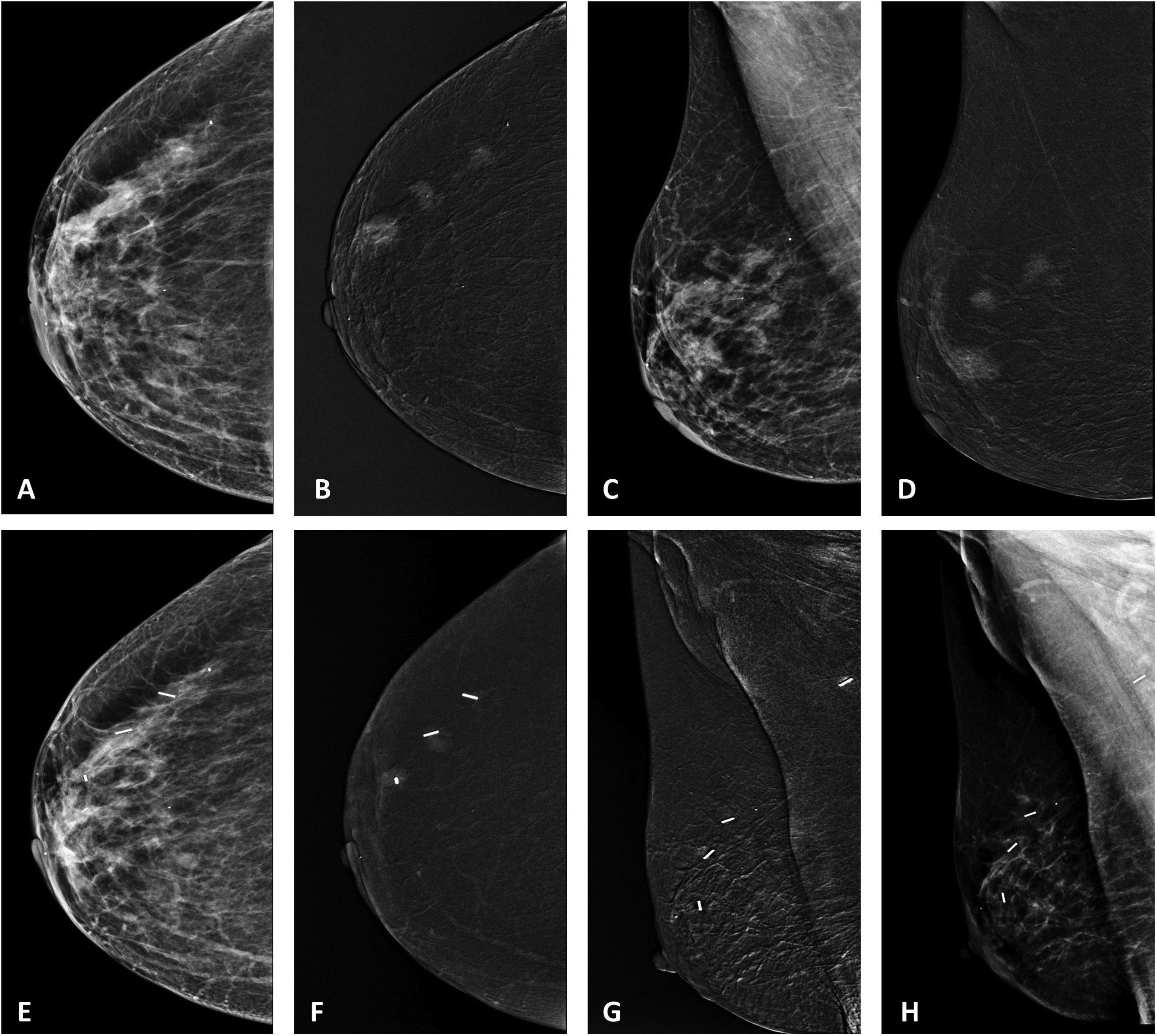 Contrast-enhanced mammography and preoperative magnetic seed placement ...