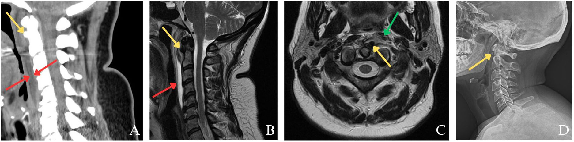 Calcific tendinitis of the longus colli muscle: From ignorance to ...