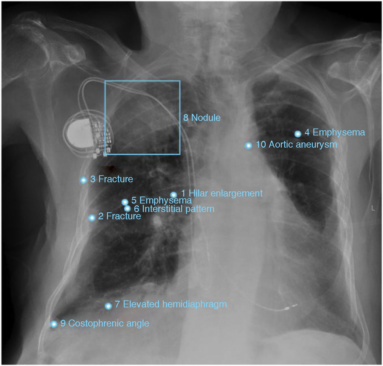 Utility of artificial intelligence for detection of pneumothorax on ...