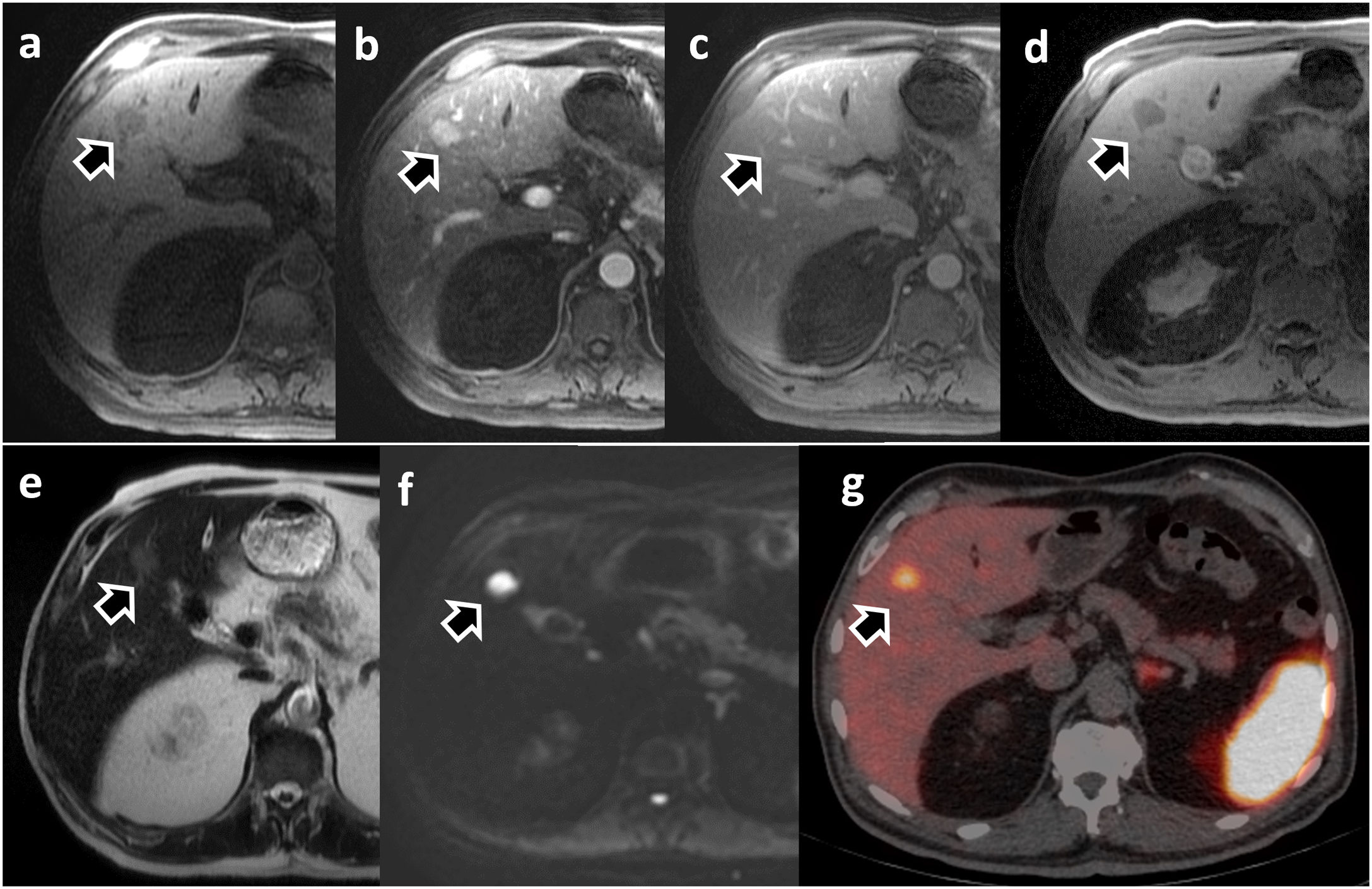 Hepatobiliary contrast agents for Liver Magnetic Resonance Imaging ...