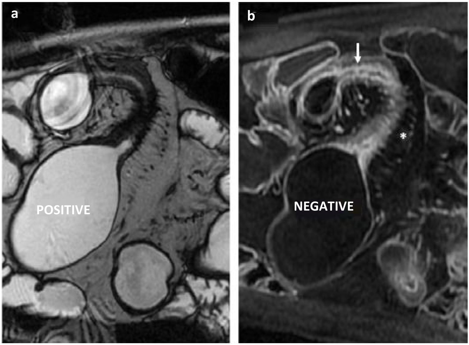 Contrast agents for MR enterography | Radiología (English Edition)