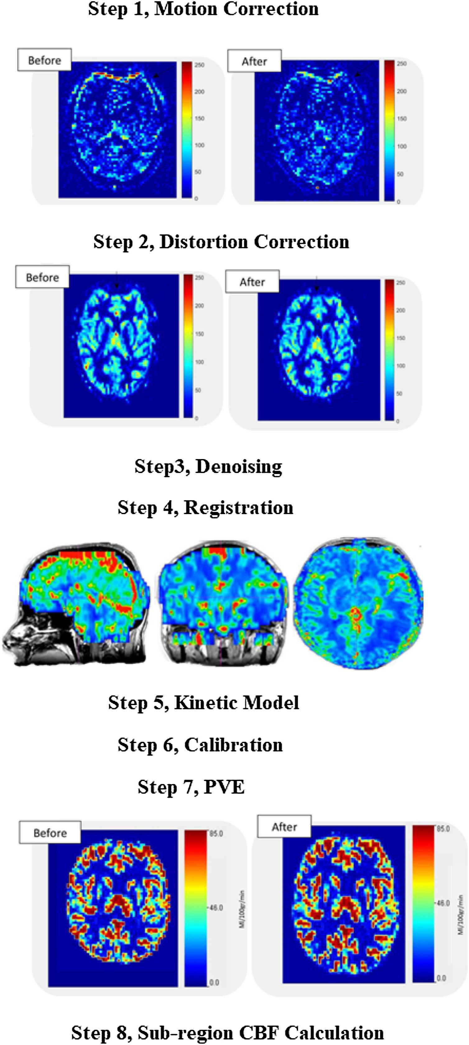 Cerebral blood flow alterations measured by ASL-MRI as a predictor of ...