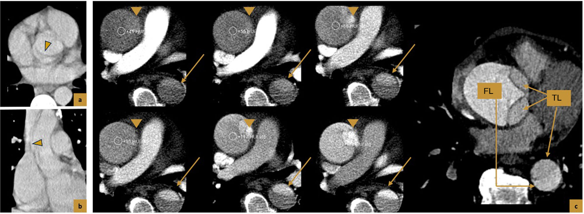 Acute aortic syndrome: What do you need to know? | Radiología (English ...
