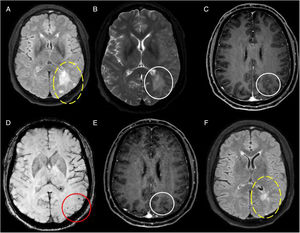 Immune-mediated encephalopathy (NICE lesions) following endovascular ...